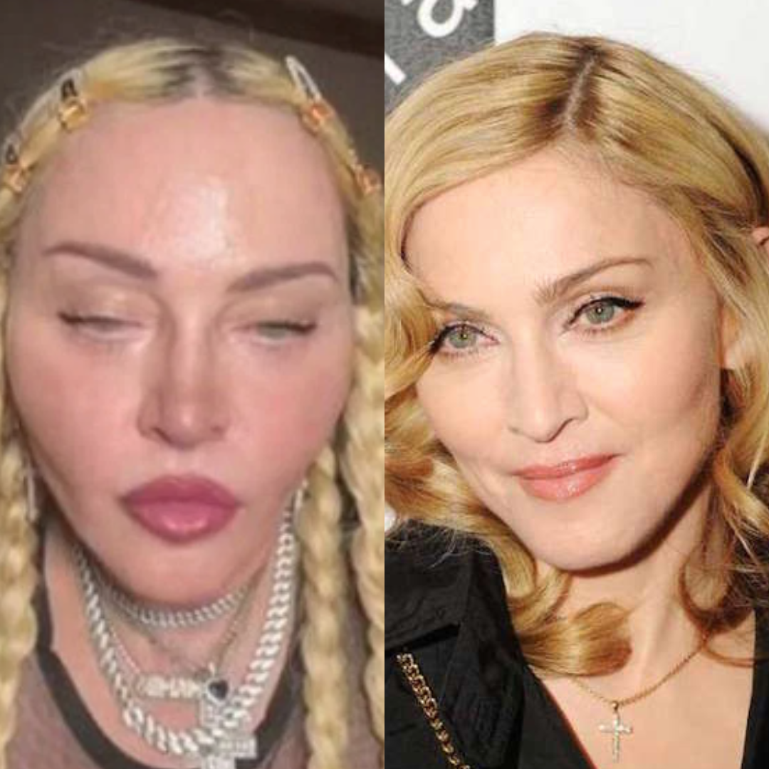 Madonna Undergoing Procedure To "Look More Like Herself" Following ...